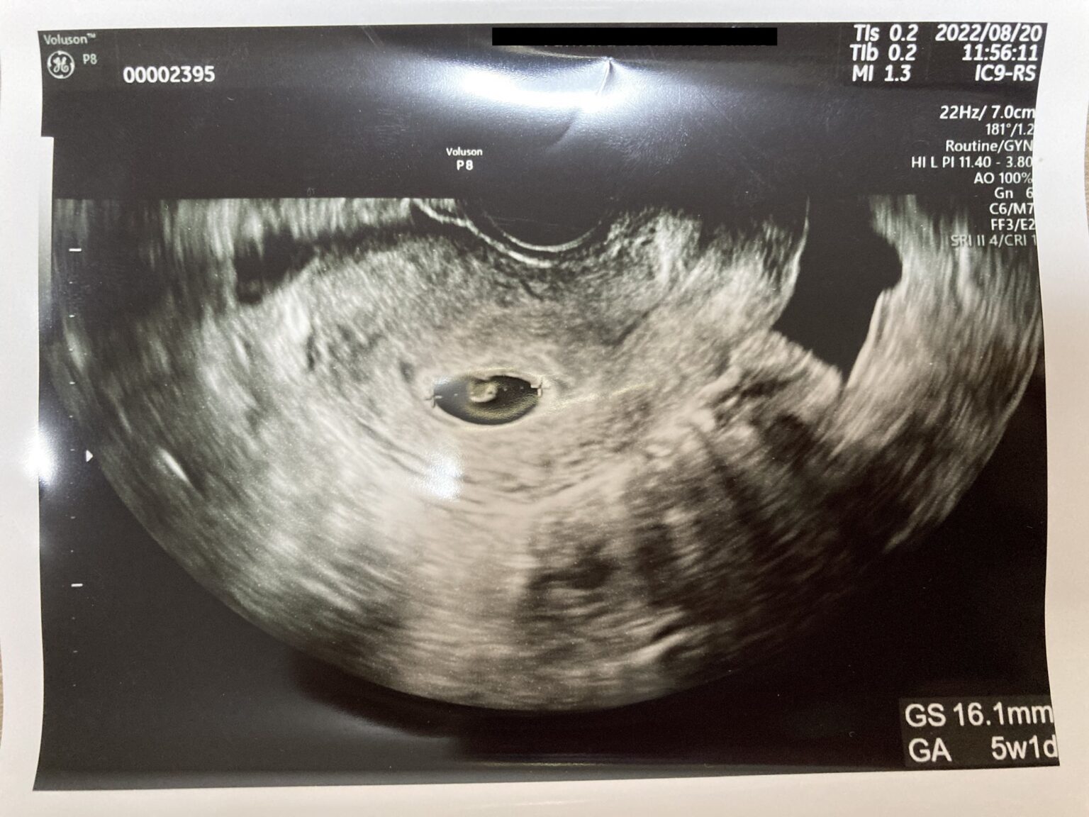 【5w5d】初診で胎嚢＆卵黄嚢 確認！ | タキまおダイアリー